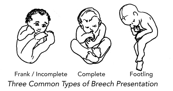 Breech Baby - A Guide to Breech Presentation - Spinning Babies